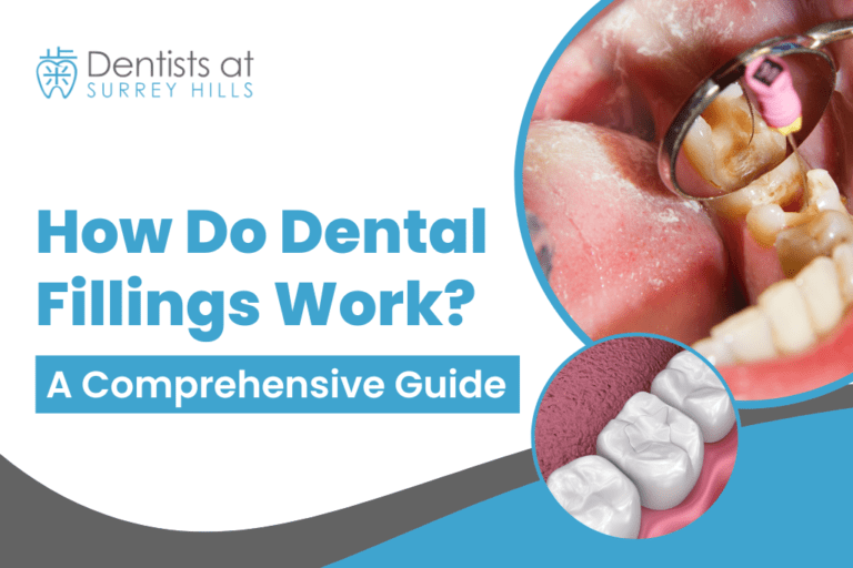 How Do Dental Fillings Work? | Dentists at Surrey Hills